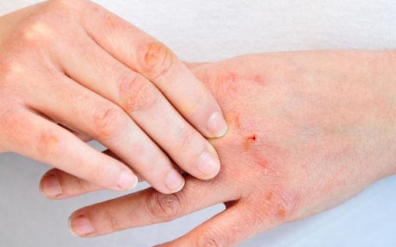 NV | Diferentes causas que pueden provocar la aparición de los nudillos ...