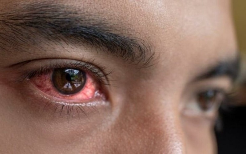 NV | ¿Cómo prevenir el tracoma?